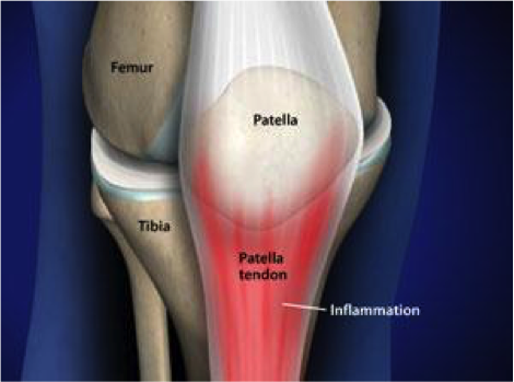 Patella Tendinopathy - Capital Physiotherapy