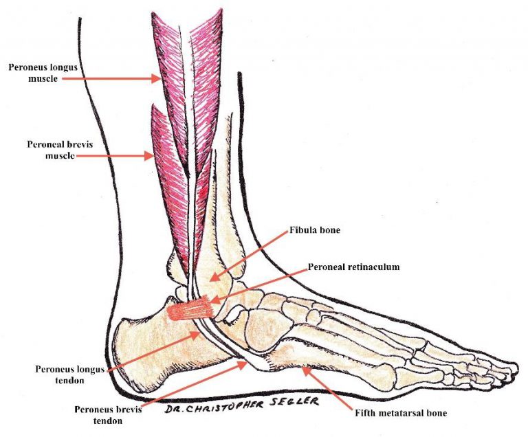Peroneal Retinaculum Tear - Capital Physiotherapy
