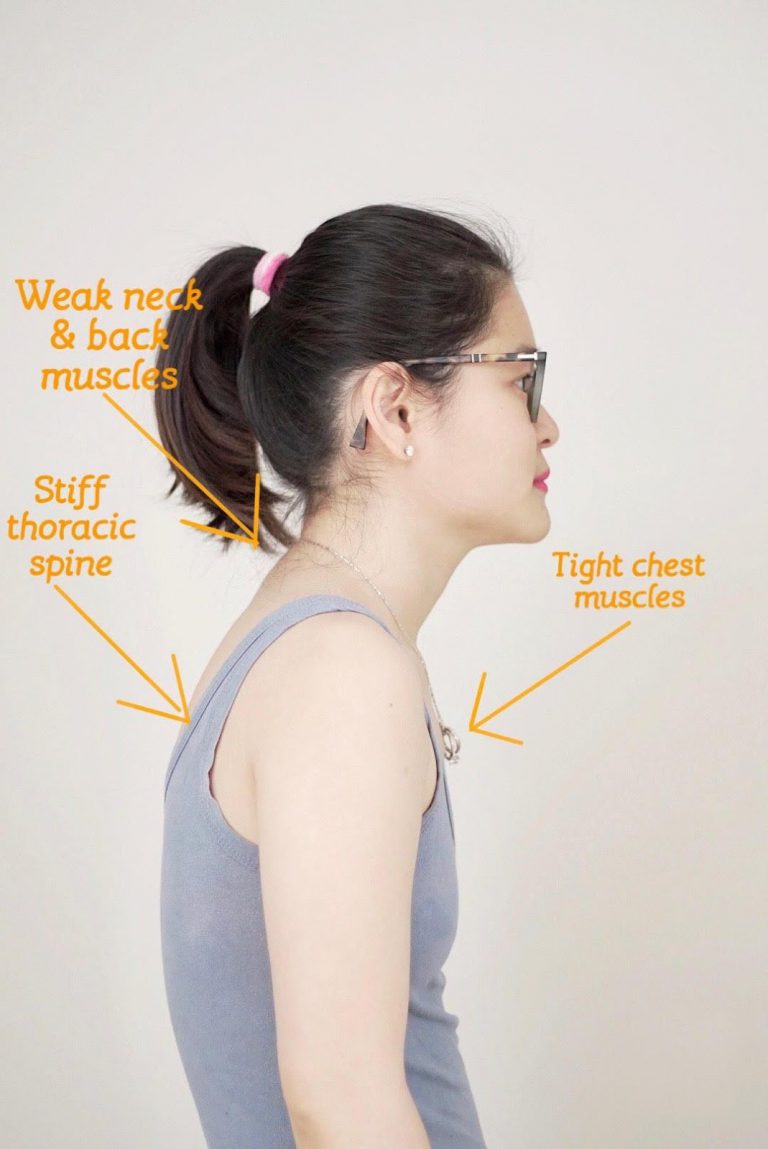 How to Fix Rounded Shoulder - Capital Physiotherapy