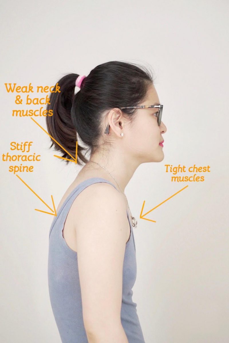 How to Fix Rounded Shoulder - Capital Physiotherapy